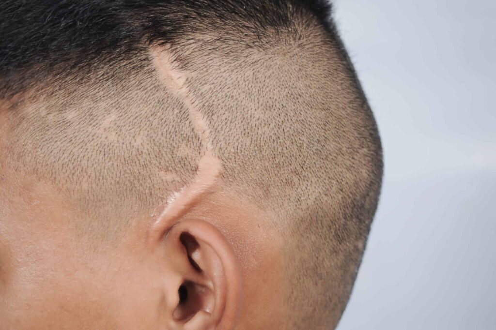 What to Do if You Have Suffered From Scarring or Disfigurement